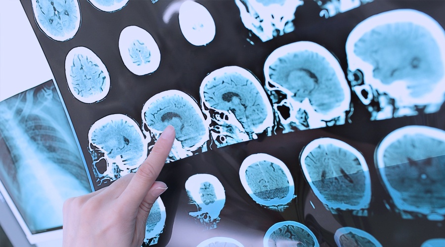 4 Types of Brain Injuries